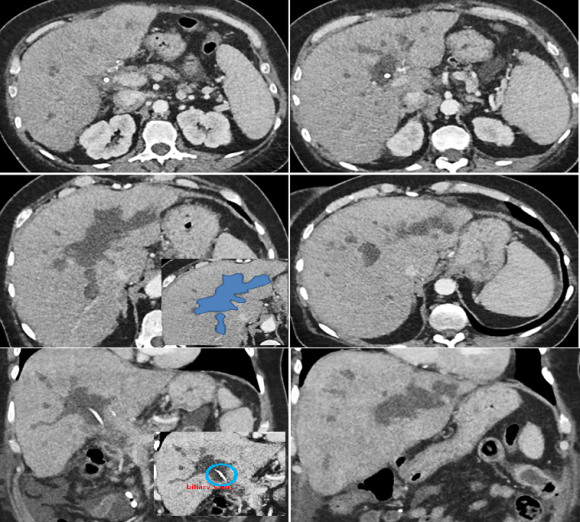 Case_Study_550_고빌리루빈혈증을 앓고 있는 54세 여성_담관 원주 증후군(Biliary cast syndrome ...