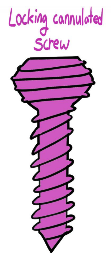 ORIF Screw 알아보기 cortical screw, locking screw, locking cannulated screw ...