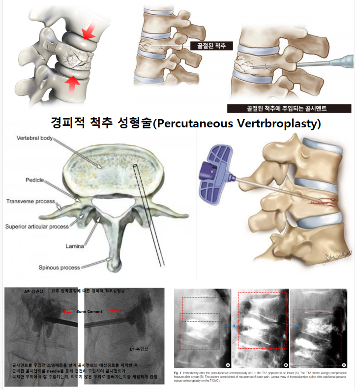 경피적 척추 성형술(Percutaneous Vertebroplasty, VP) : 네이버 블로그