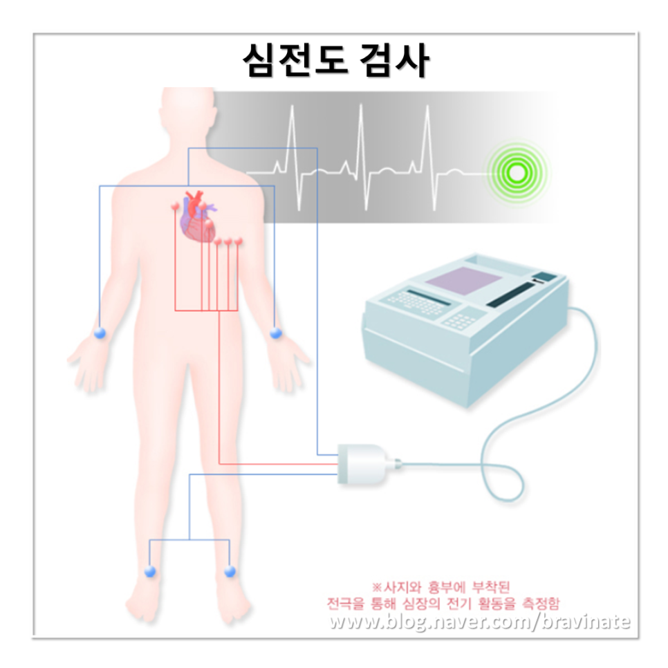 죽상경화증 의미 원인 증상 증세 진단 검사 치료 시술 수술 약물 운동 음식 네이버 블로그