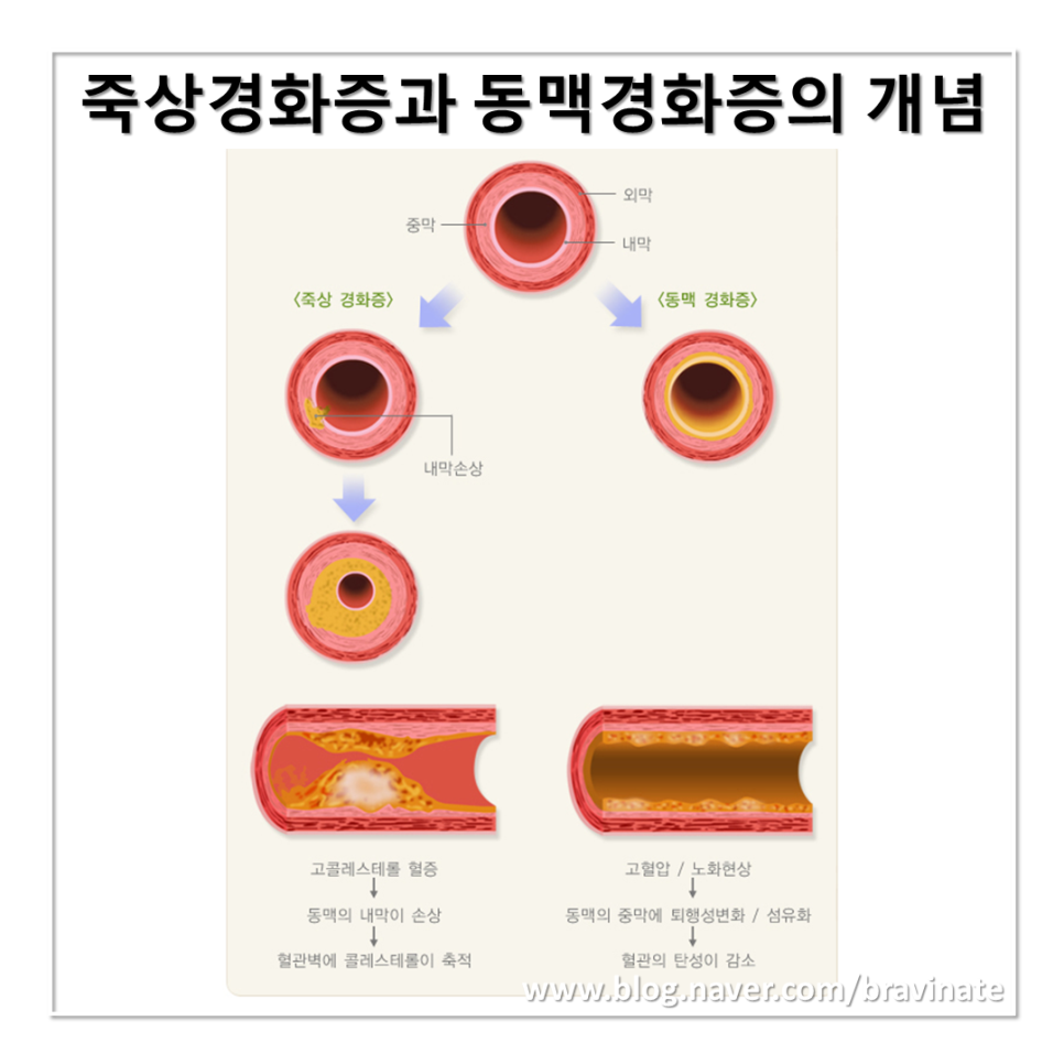 죽상경화증 의미 원인 증상 증세 진단 검사 치료 시술 수술 약물 운동 음식 네이버 블로그