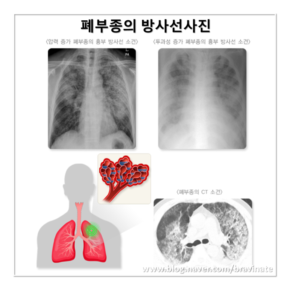 폐부종 원인 증상 증세 진단 검사 치료 시술 수술 약물 폐울혈 급성 음식 네이버 블로그
