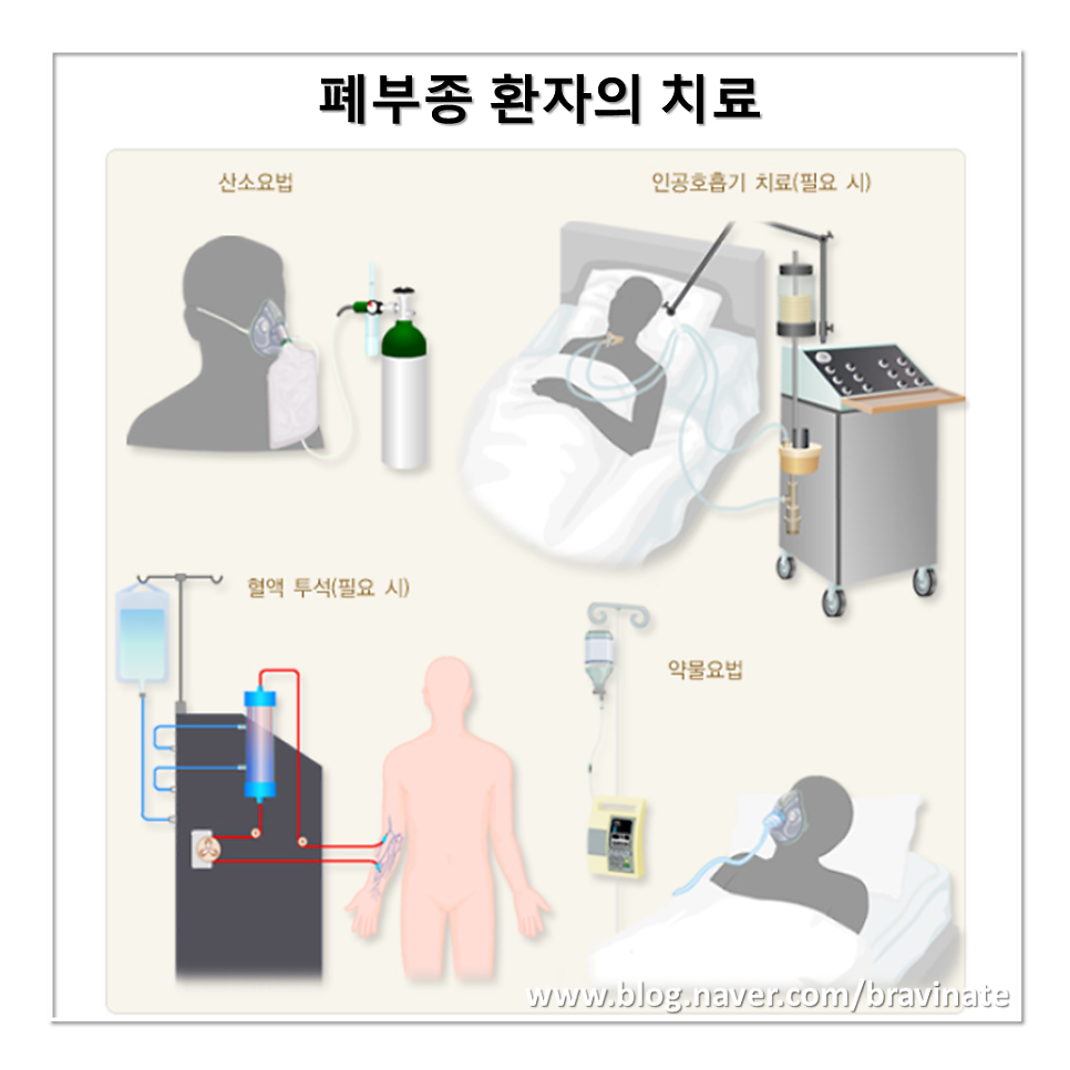 폐부종 원인 증상 증세 진단 검사 치료 시술 수술 약물 폐울혈 급성 음식 네이버 블로그
