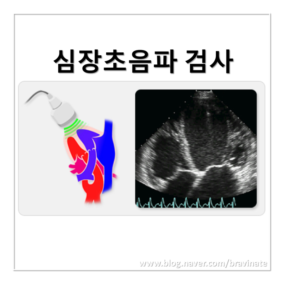 폐부종 원인 증상 증세 진단 검사 치료 시술 수술 약물 폐울혈 급성 음식 네이버 블로그