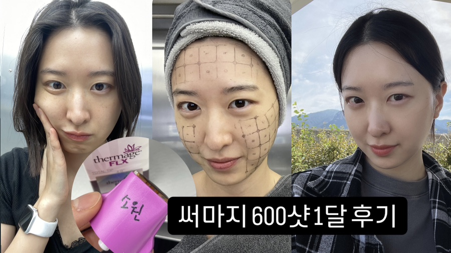 써마지 FLX 600샷 한달 후기 (통증 가격 효과) : 네이버 블로그