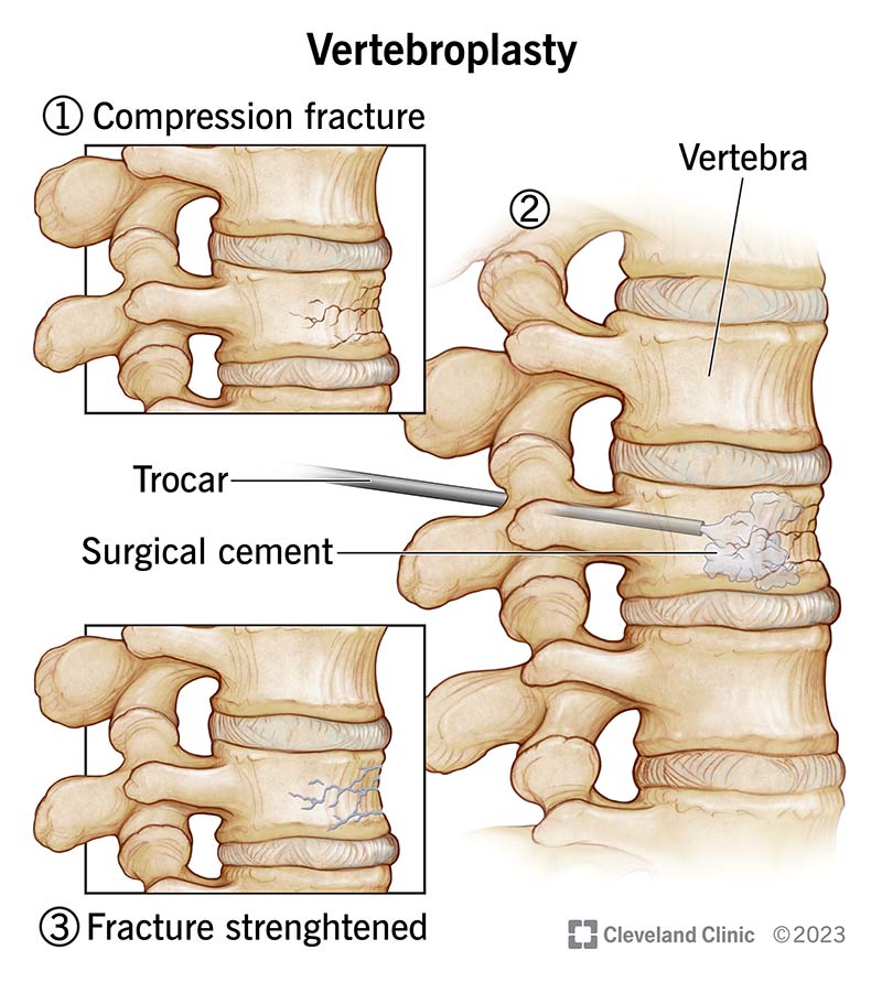 척추성형술(Vertebroplasty)🦴 : 네이버 블로그