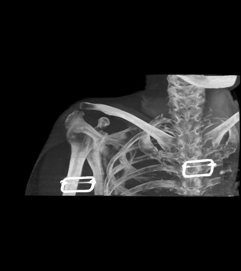 오구돌기 골절의 고정(coracoid process fracture) : 네이버 블로그
