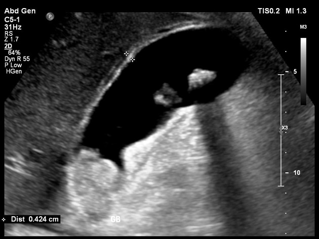 급성 담낭염 (Acute cholecystitis)의 정의, 원인, 증상, 진단 및 치료 : 네이버 블로그