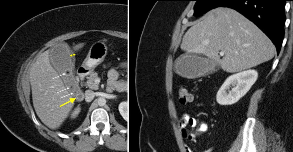 급성 담낭염 (Acute cholecystitis)의 정의, 원인, 증상, 진단 및 치료 : 네이버 블로그