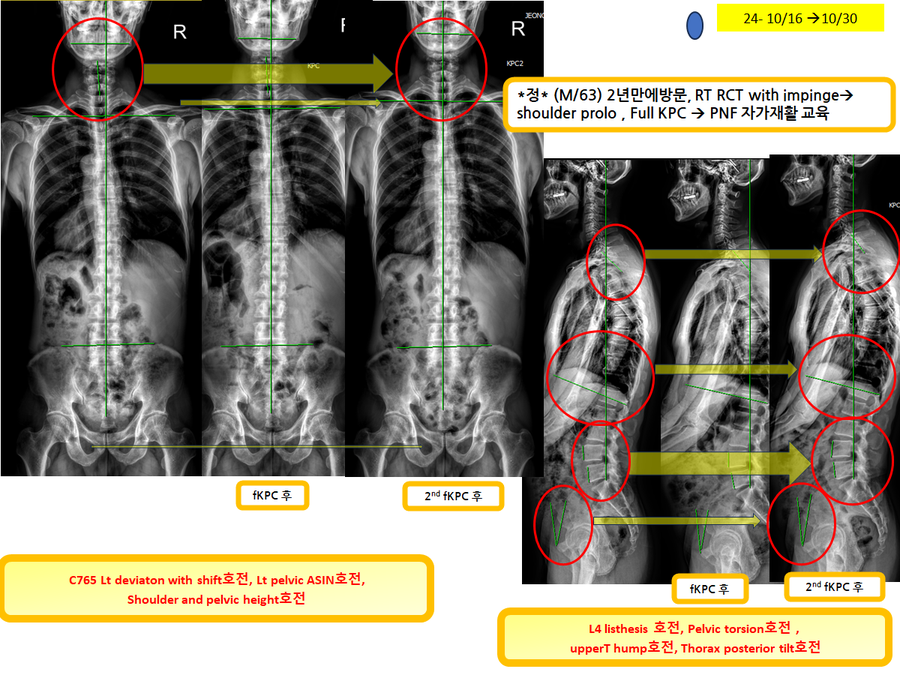 우측어깨 통증으로 2번째 full KPC 시행하신 분(녹는실KPC치료는 엑스레이 호전을 10분만에 확인) : 네이버 블로그