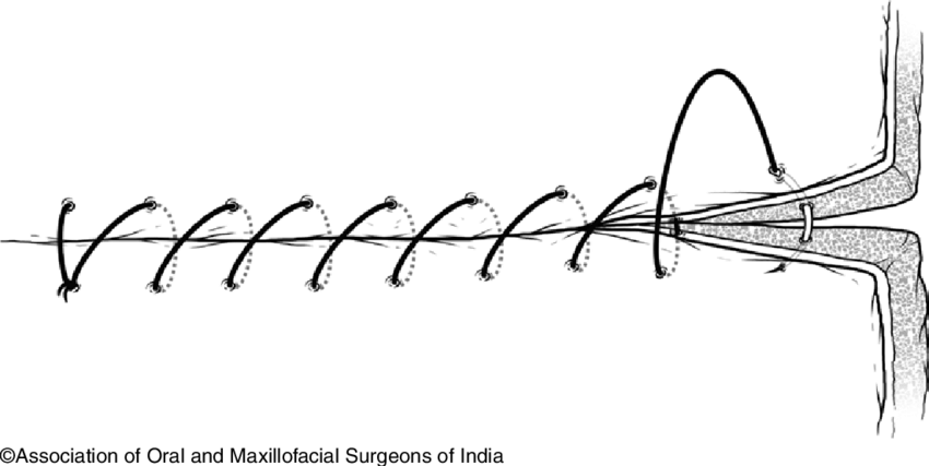 백투더수처 - 3장 봉합 Suture (1) : 네이버 블로그