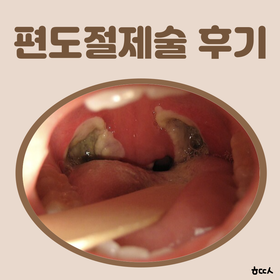 편도절제술 비용 편도절제술 후기 1일차~4일차 편도완전절제술 편도제거수술 음식 실비 출혈 네이버 블로그