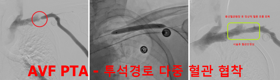 CASE review : 투석혈관 다중협착병변 혈관성형술(AVF PTA) : 네이버 블로그