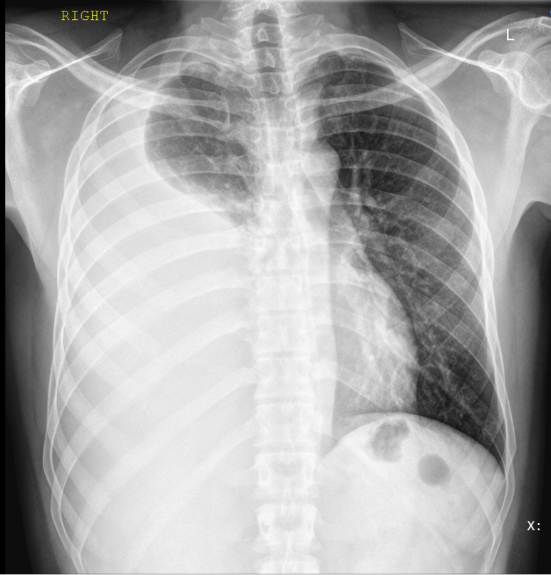 엑스레이의 모든 것 : chest x-ray CXR 엑스레이 보는 방법, Consolidation, GGO, Pleural effusion, Atelectasis 무기폐 ...