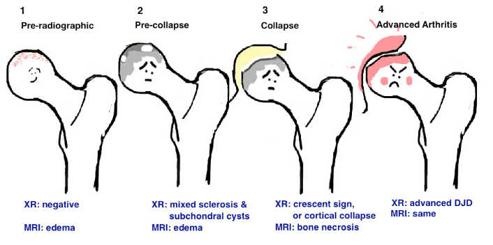 BPHA : 네이버 블로그
