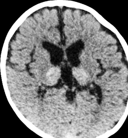 백질이영양증(Leukodystrophy): CT/MRI 영상으로 이해하는 희귀 백질 질환 : 네이버 블로그