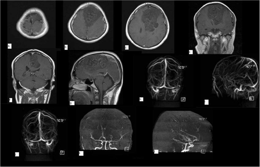 뇌 MRI, MRA, MRV 뜻, 차이, 차이점 / angiography 의미 : 네이버 블로그