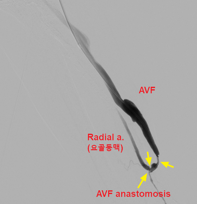 투석혈관 Juxta anastomosis site AVF PTA 치료case : 네이버 블로그