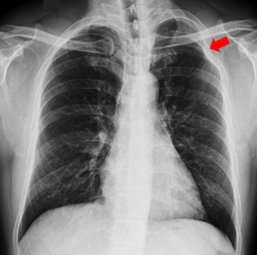 Case Study_948:좌측 제3늑골 저형성(Hypoplastic Left Third Rib)-희귀 흉곽 기형의 진단과 해석 ...