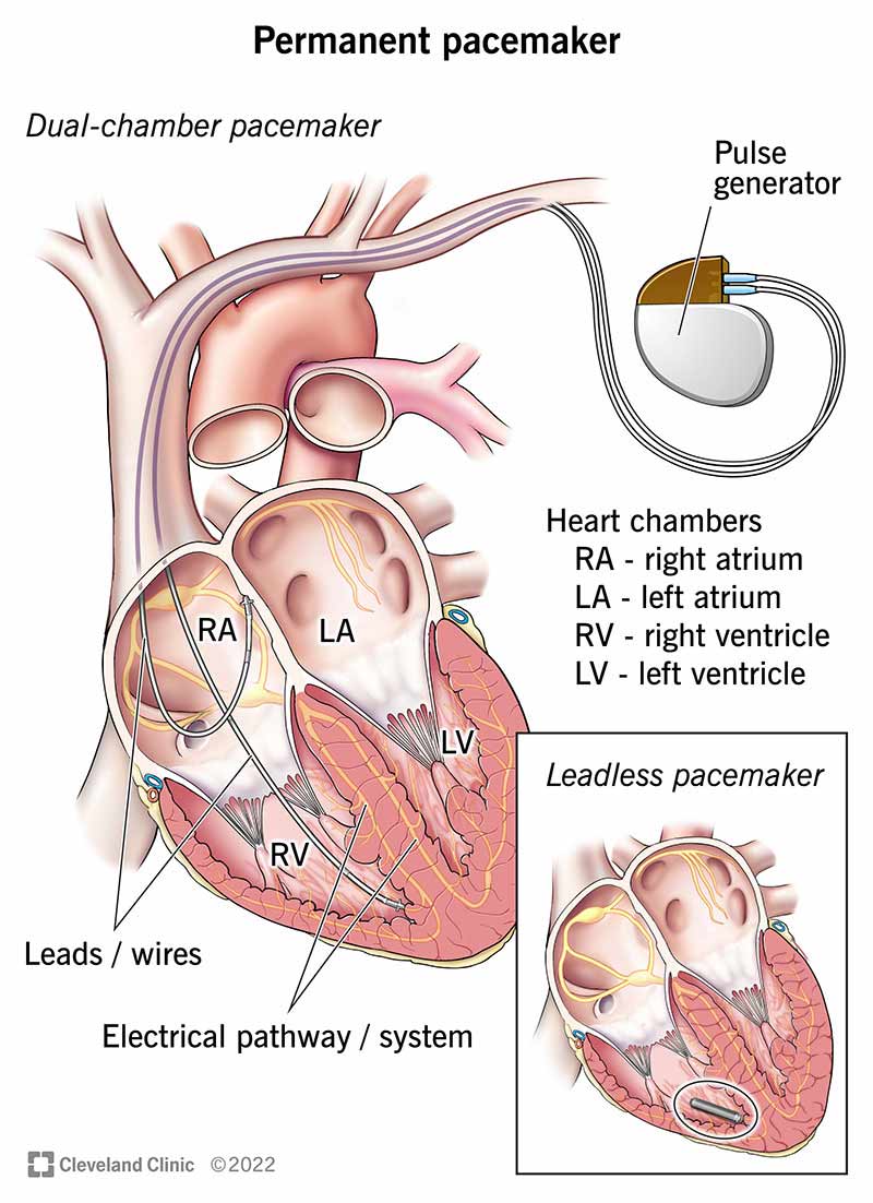 인공심박동기(Pacemaker) 기본 알기! 정의 및 역할, 구조, 검사/간호/약물 알아보자! : 네이버 블로그