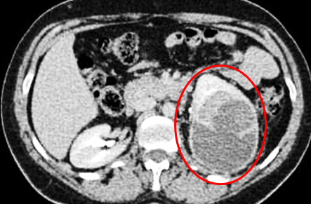 Case Study_1014:옆구리 통증과 혈변을 보는 41세 여성-피막하 콩팥주위 혈종(Subcapsular perirenal ...