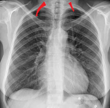 Case Study_1013:건강 검진을 위해 가슴사진을 찍은 34세 여성-불완전한 비대칭 경추 갈비뼈(Rudimentary ...