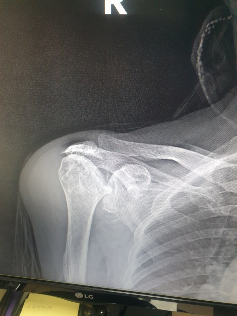 견관골 상환골두 괴사 수술 : 네이버 블로그