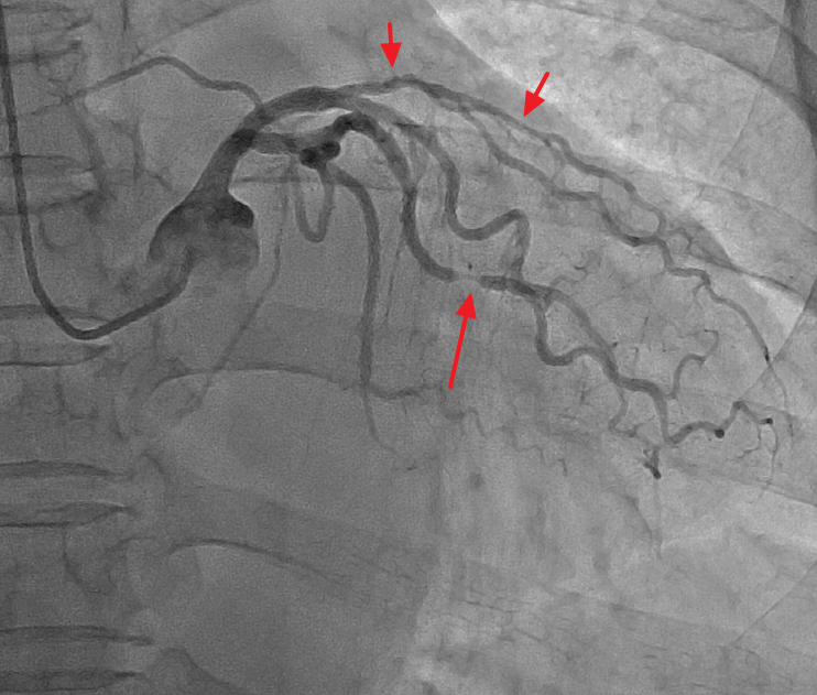 LCX OM 병변 PCI case : 네이버 블로그