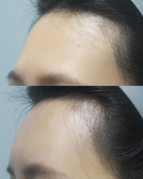 [부산이마필러] 실제 변화로 보는 자연미 살리는 이마필러 !! : 네이버 블로그