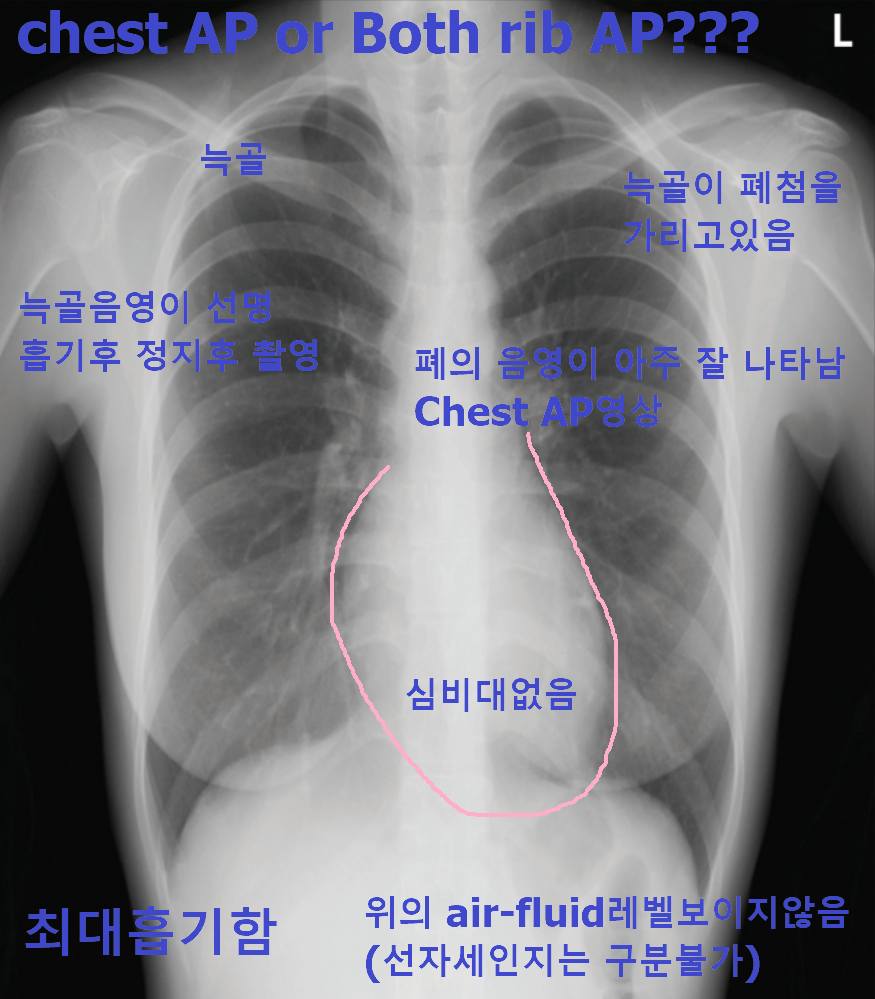 일반촬영 Chest AP , Apicogram 심심할때 풀어보는 국시 예상문제 : 네이버 블로그