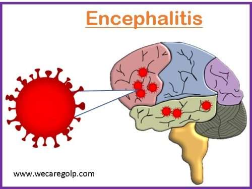 인플루엔자 뇌염 (Influenza encephalitis) : 네이버 블로그