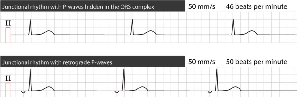 Junctional rhythm 정의와 치료에 대해 자세히 알아봐요! : 네이버 블로그