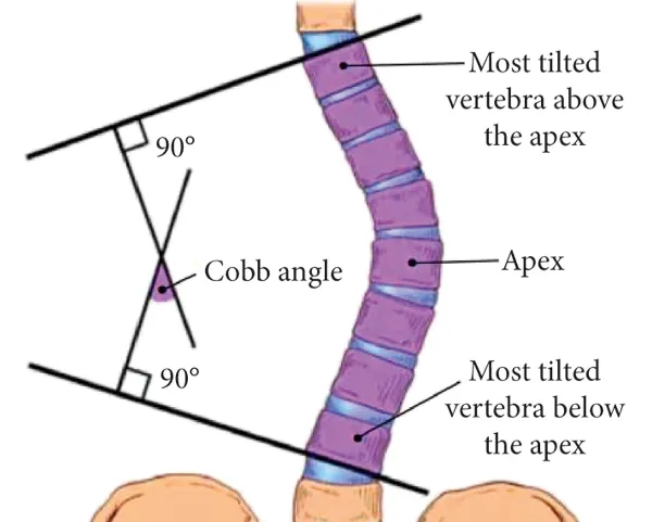 콥스각(cobb's angle)과 리서 사인(Risser sign) : 네이버 블로그