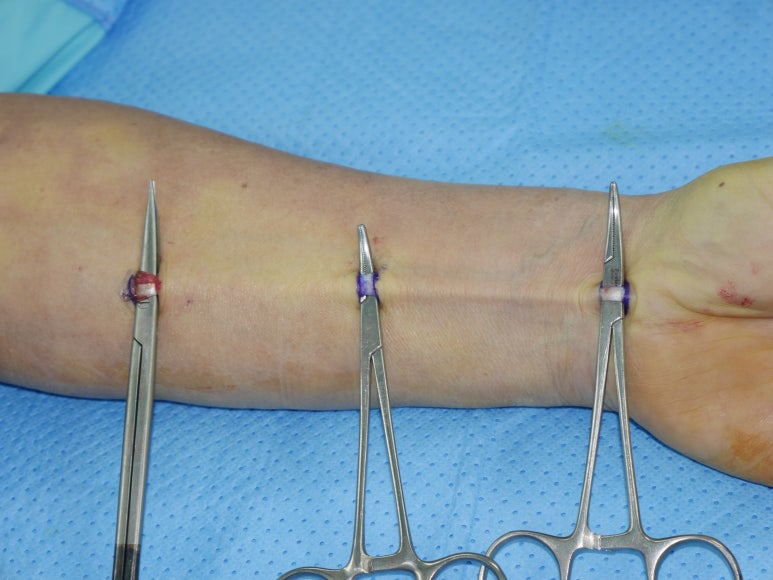 M/66 FDP RE-RE rupture, PL graft. : 네이버 블로그