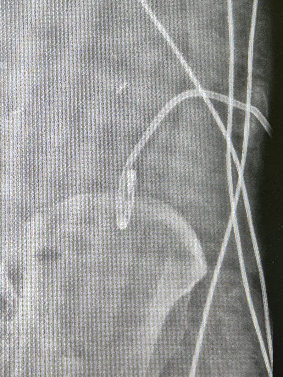 PCD Percutaneous Catheter Drainage 의학용어 의미 시술 : 네이버 블로그