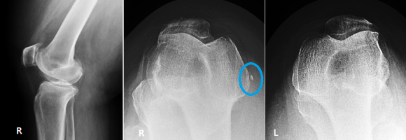 Case_Study_712:오른쪽 무릎 만성 통증이 있는 54세 여성_펠레그리니-스티에다 병변(Pellegrini-Stieda ...