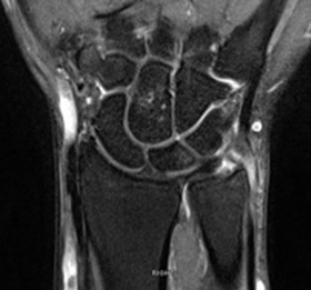 손목 삼각섬유연골복합체 손상, TFCC injury : 네이버 블로그