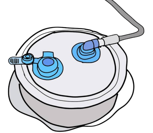 Hemovac Drain 용기의 차이점(JP, Hemovac, Barovac)(이름, 재질, 압력, 용량 등등) : 네이버 블로그