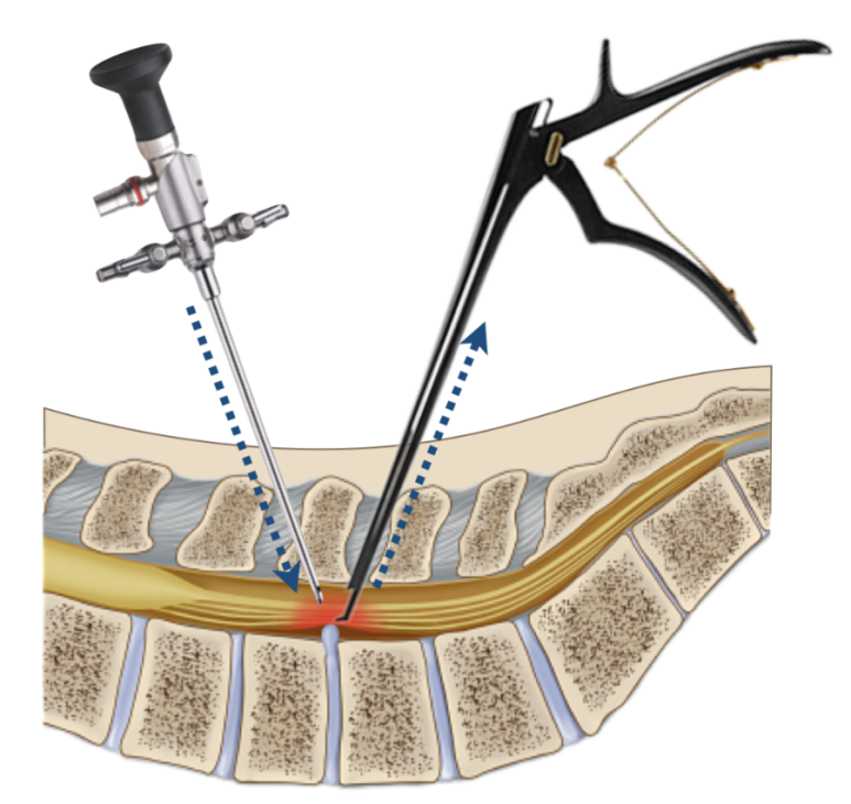 [NS수술] UBE(Unilateral Biportal Endoscopy, 양방향 척추 내시경 수술) : 네이버 블로그