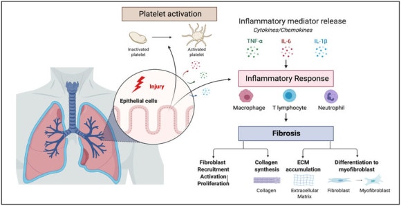 폐섬유증(Overview of pulmonary fibrosis) : 네이버 블로그