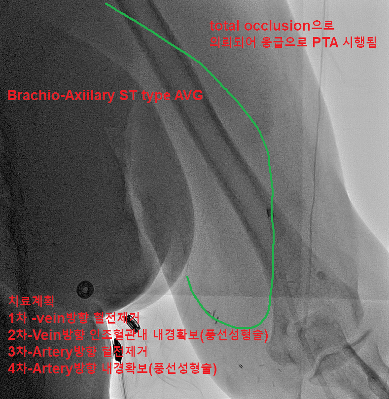 Brachio Axillary St type AVG 완전폐색에 따른 혈전제거술 및 풍선혈관성형술(BA ST AVG PTA ...