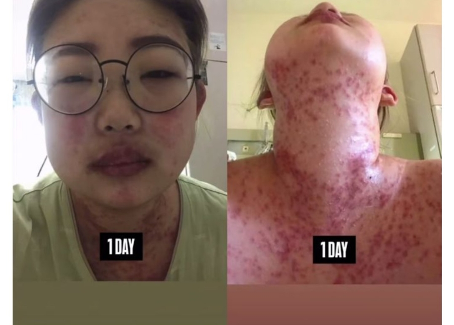 “96kg→41kg, 루푸스를 이겨낸 소녀의 반전 이야기 💪💖”💫 “이게 나 맞아?” 최준희, 극적인 비포&애프터 공개… 루푸스 이겨낸 놀라운 근황 : 네이버 블로그