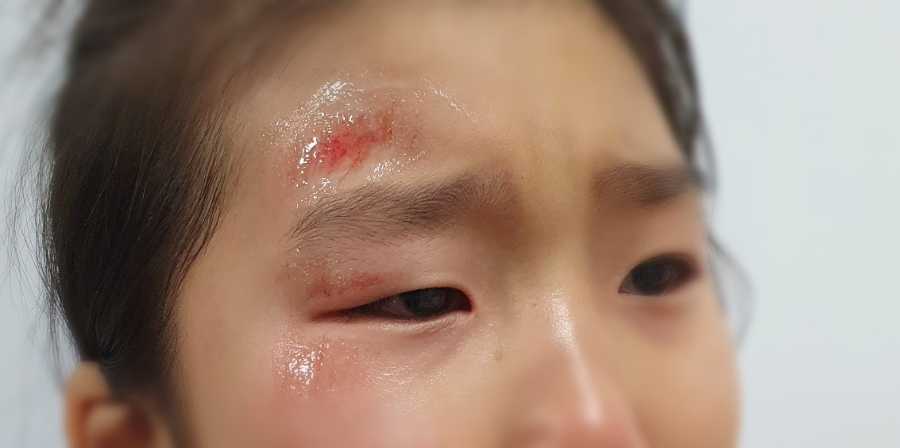 넘어진 상처 진물 얼굴 찰과상 연고 병원 복용약 한달 치료 과정 : 네이버 블로그