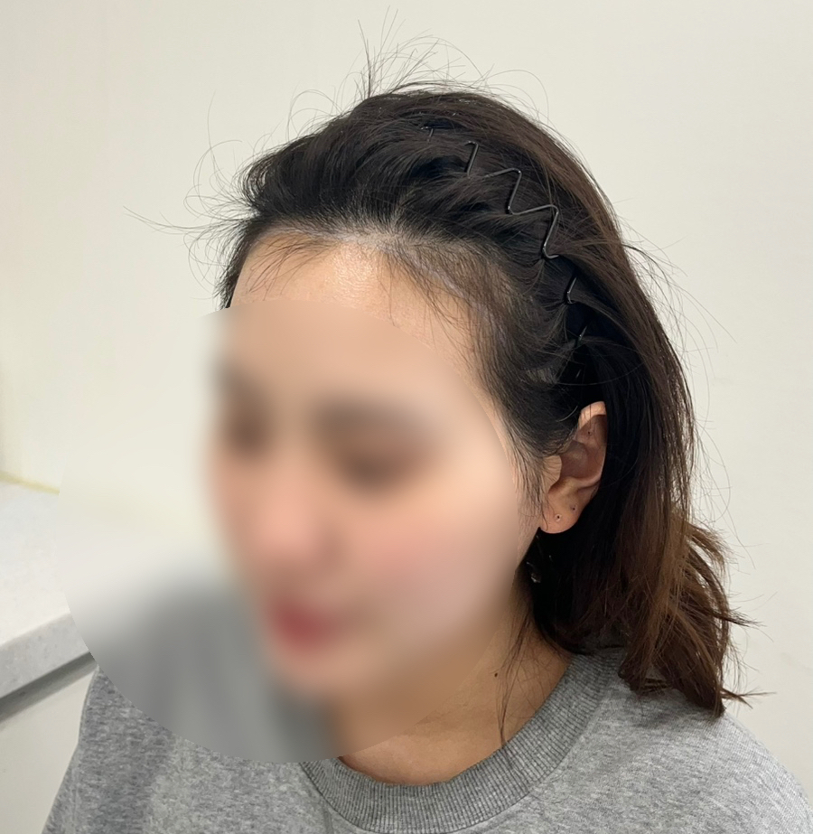 합정 DD.SMP 자연스러운 헤어라인 두피문신 3회차 탈모 고민해결 : 네이버 블로그