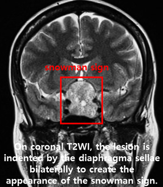 Case Review_110-두통과 양측 측두엽 반맹, 근력이 약화된 51세 여성- Pituitary macroadenoma ...
