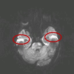 MRI artifact : 네이버 블로그