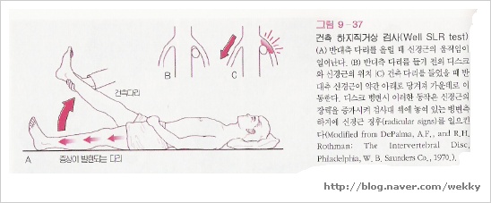 하지직거상검사(SLRT) 의 의미 : 네이버 블로그