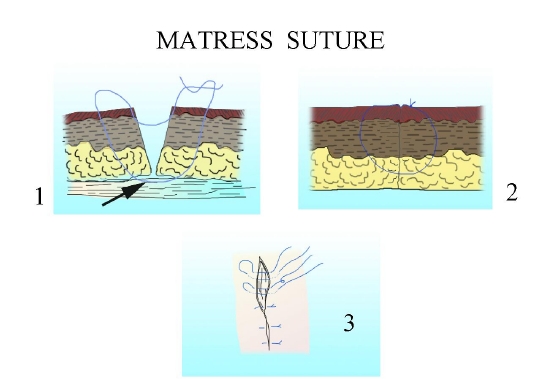 이 많은 실들을 어떻게 다 외워?(4) - Prolene : 네이버 블로그