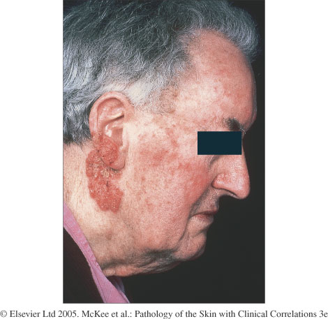 [병리] 광선각화증 (Actinic keratosis) : 네이버 블로그