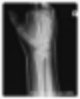 Fx. distal radius(intraarticular) & ulnar styloid process : 네이버 블로그